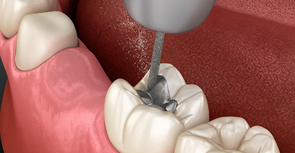 Amalgam Removal Services - ST Tiew Dental Group